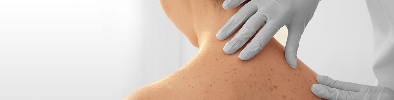 Dermatologista alerta sobre pintas que podem virar câncer de pele | HCor